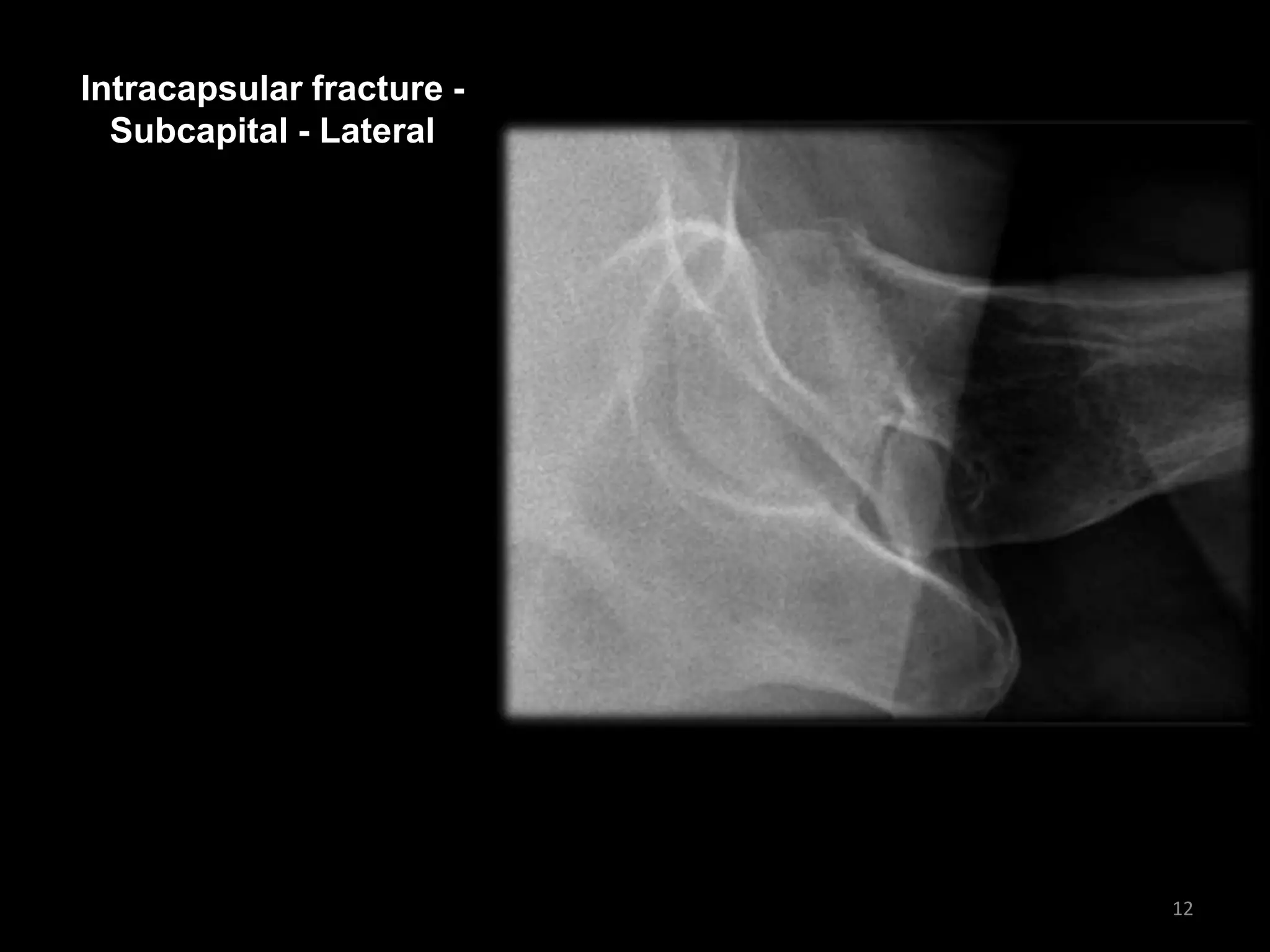lowerlimbfractures-170325175714.pdf