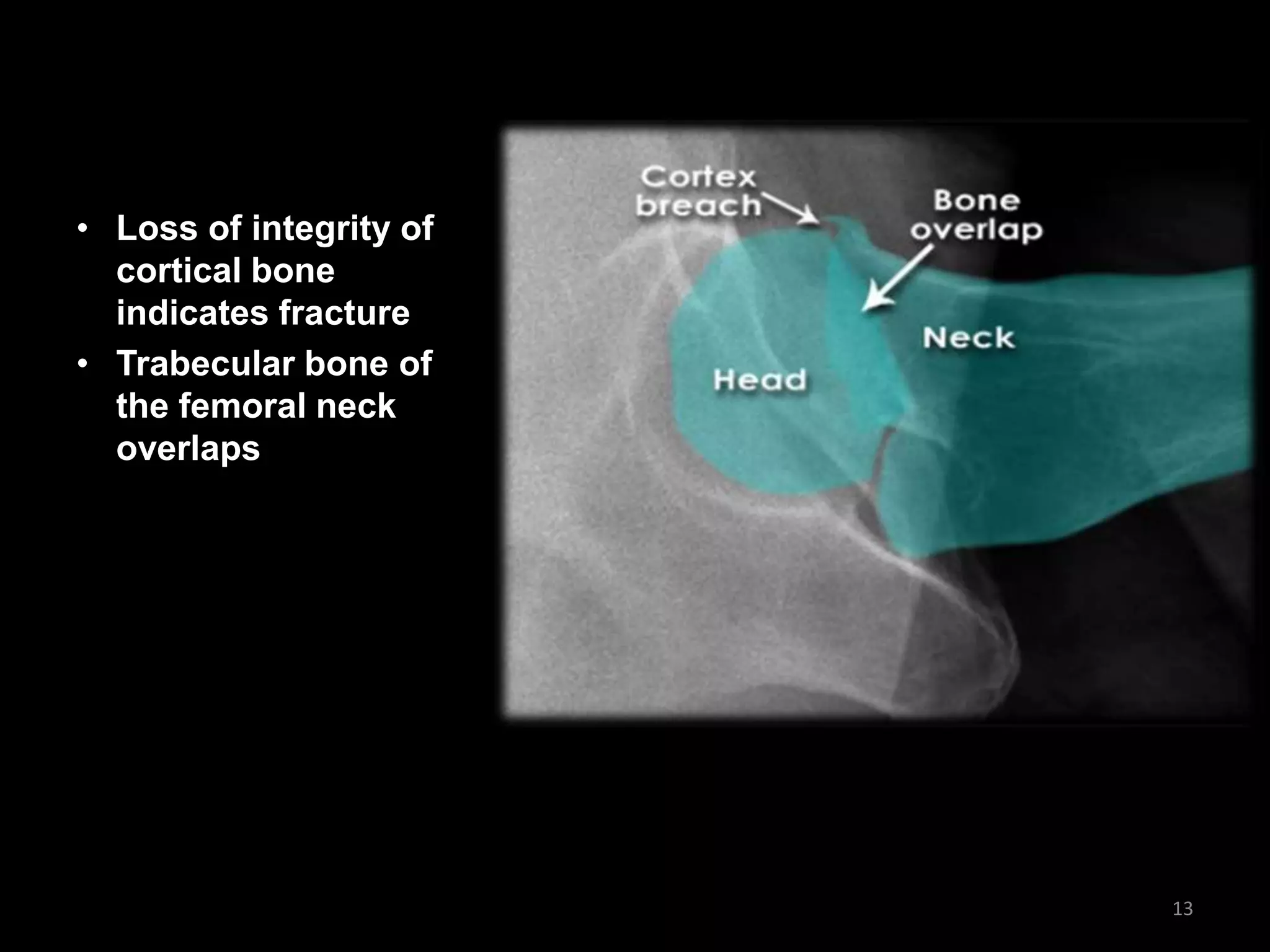 lowerlimbfractures-170325175714.pdf