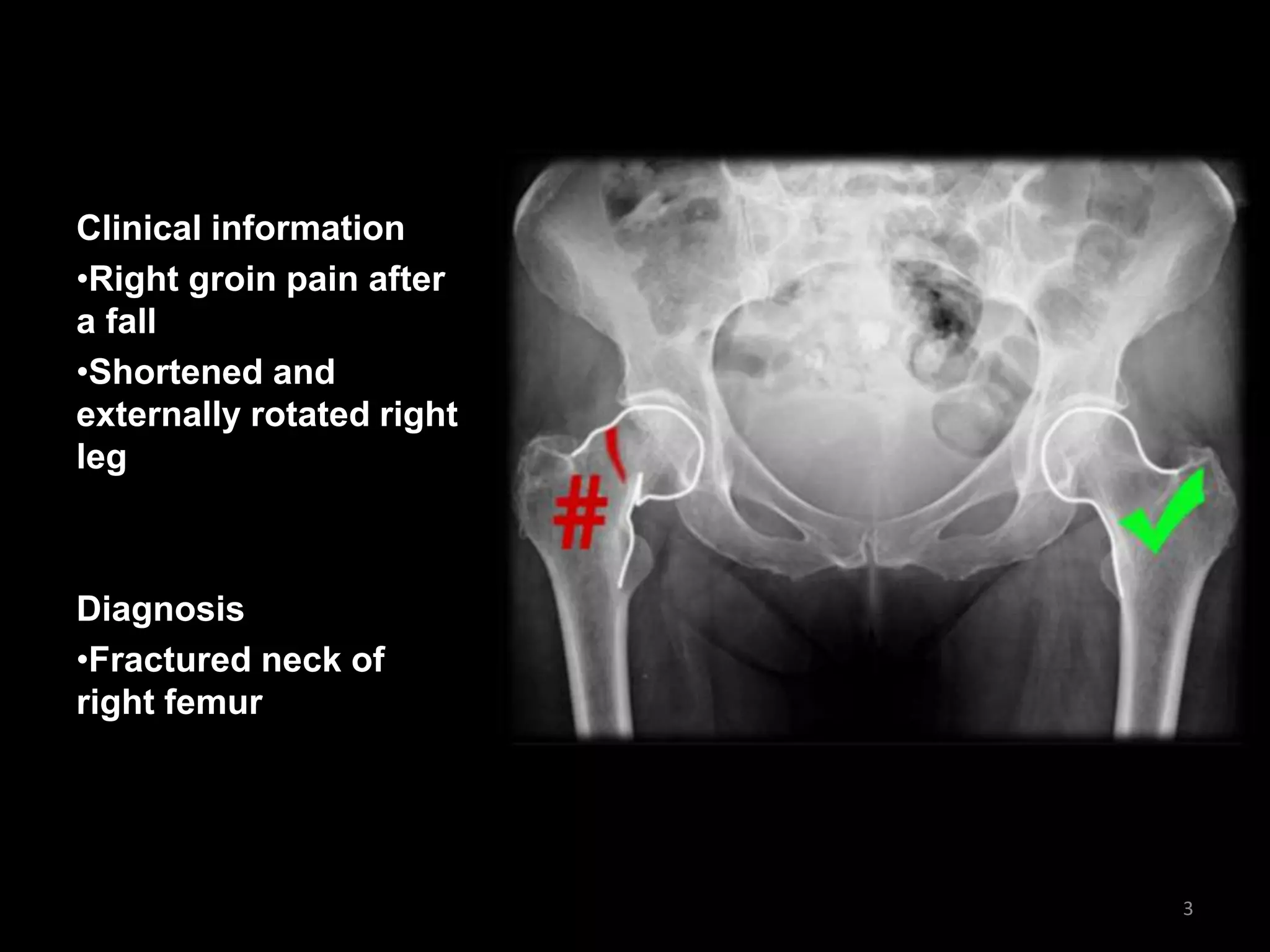 lowerlimbfractures-170325175714.pdf