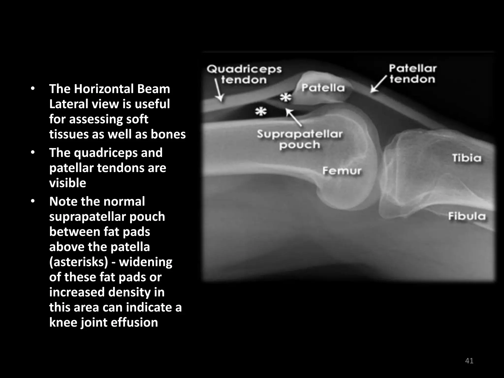 lowerlimbfractures-170325175714.pdf