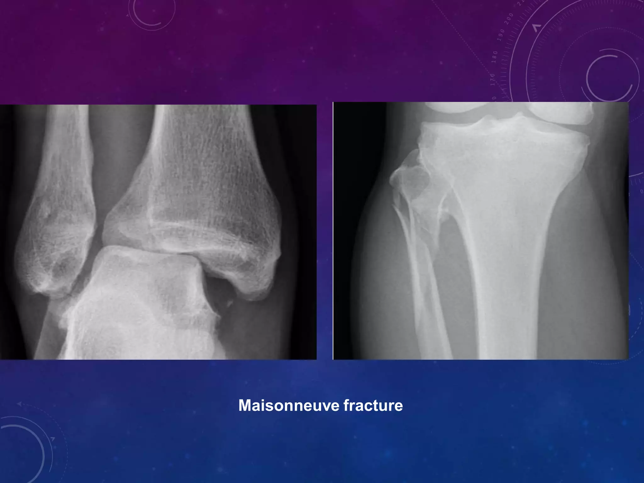 lowerlimbfractures.pptxì | PPTX | Death, Injury, or Military Conflict ...