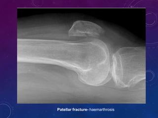 lowerlimbfractures.pptxì | PPTX