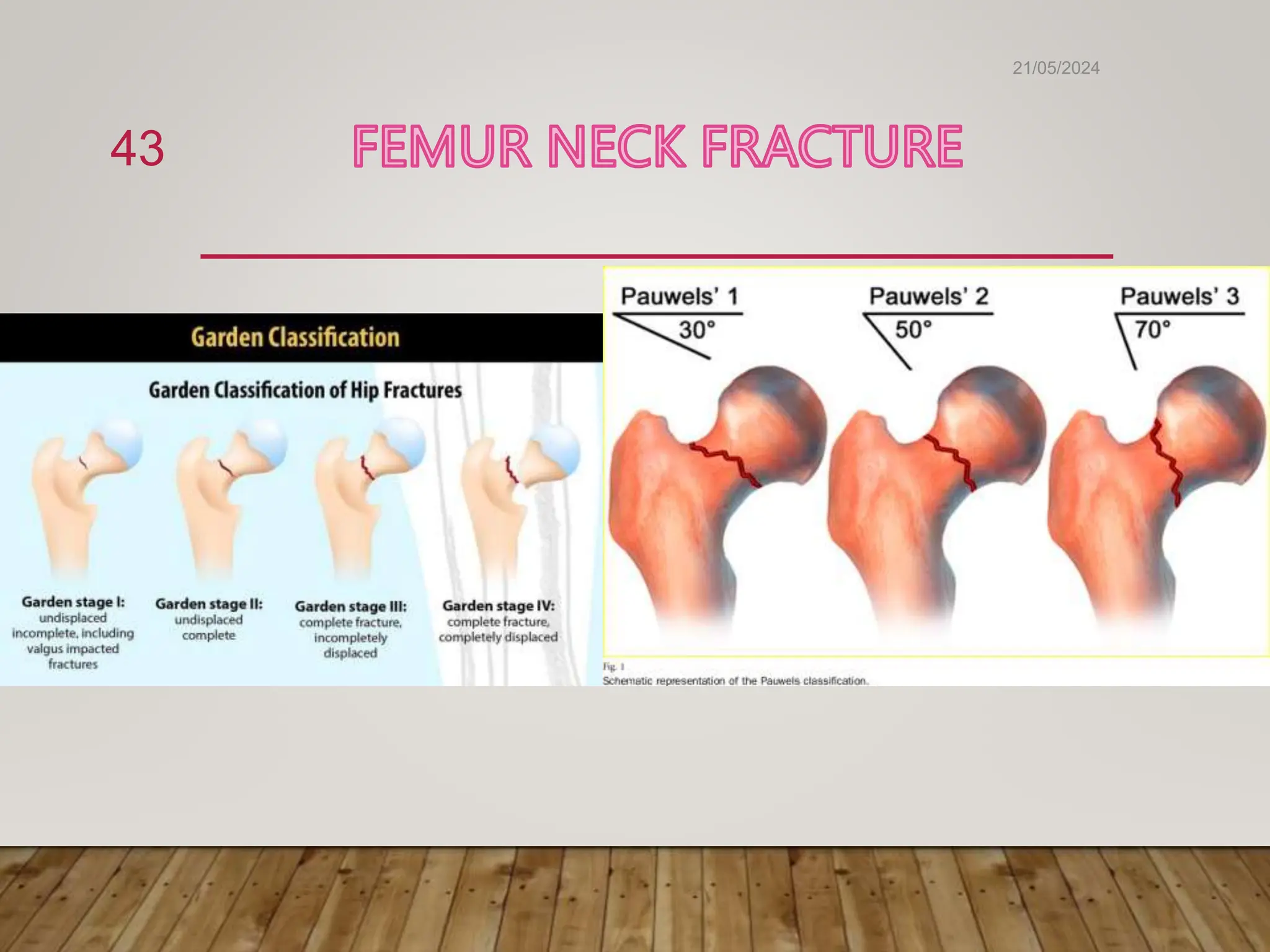 Lower Limb Fractures, orthopedic seminar.pptx