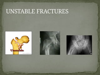 LOWER LIMB FRACTURES in adults, mva.pptx