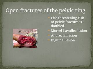 LOWER LIMB FRACTURES in adults, mva.pptx