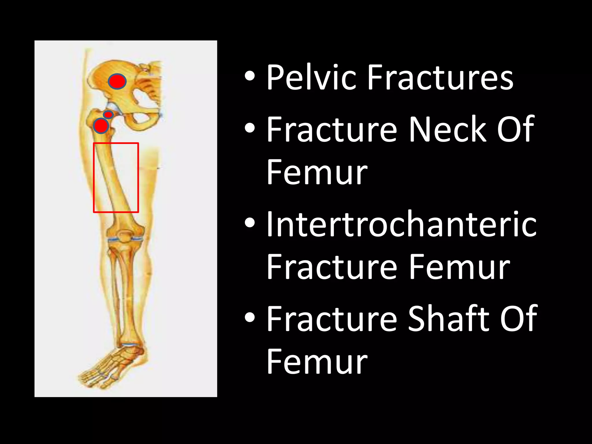 Lower limb fractures part 1 (for UGs) | PPTX