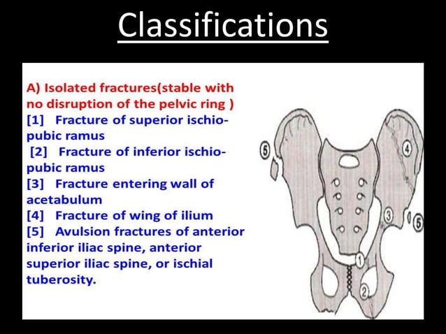 Lower limb fractures part 1 (for UGs) | PPT