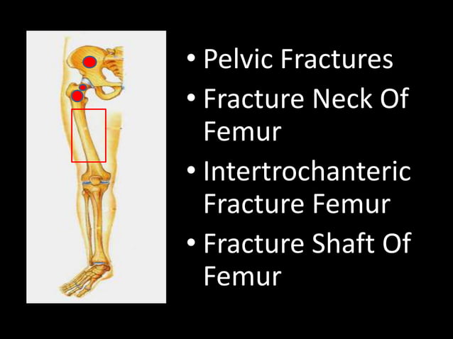 Lower limb fractures part 1 (for UGs) | PPT