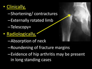 Lower limb fractures part 1 (for UGs) | PPTX