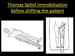 Lower limb fractures part 1 (for UGs) | PPTX