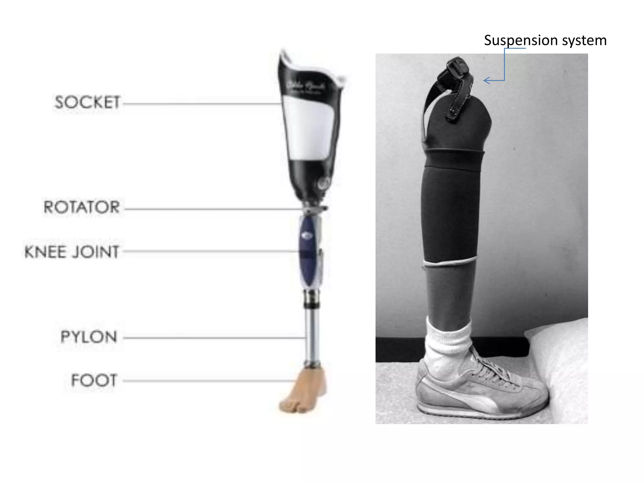 Lower limb prosthesis | PPTX
