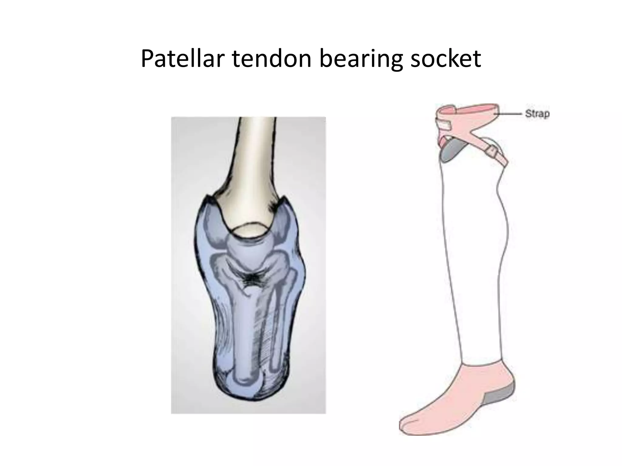 Lower limb prosthesis | PPTX
