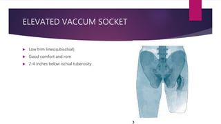 Lower limb prosthesis (hip, knee) | PPTX