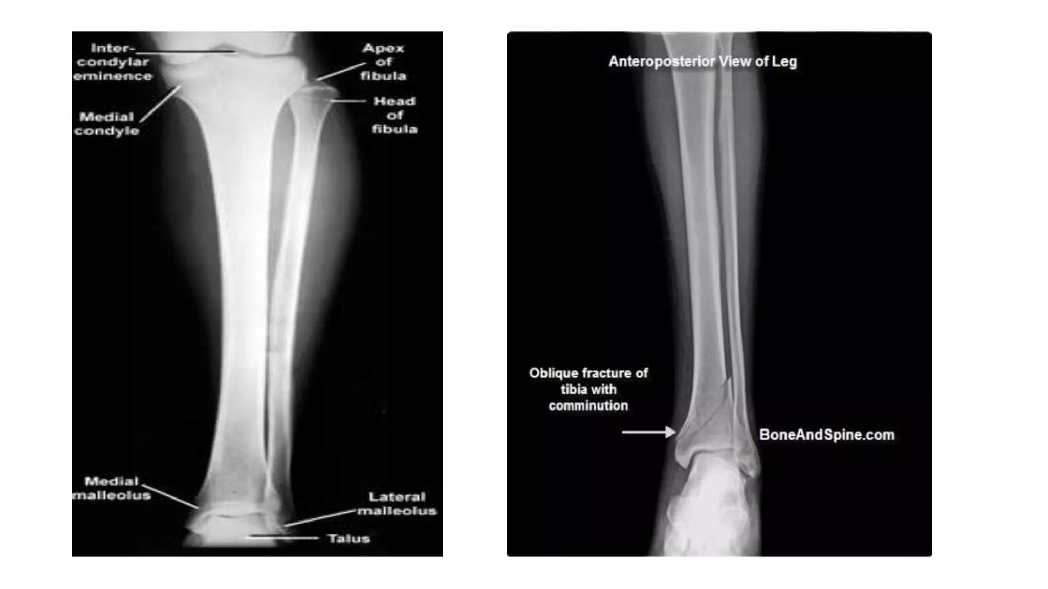 Lower limb radiology | PPTX