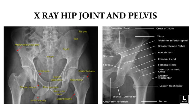 Lower limb radiology | PPTX | Death, Injury, or Military Conflict ...