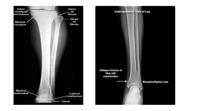 Lower limb radiology