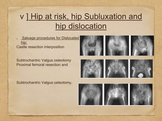 Lower limb reconstruction in tetraplegia | PPTX