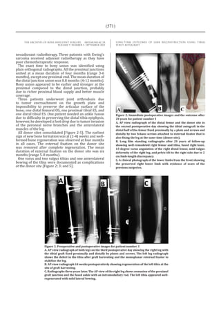Lower Limb Reconstruction Using Tibial Strut.pdf | Bone and Joint ...