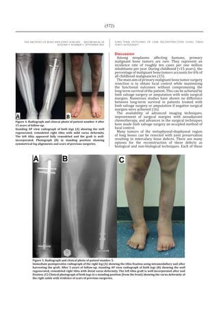 Lower Limb Reconstruction Using Tibial Strut.pdf