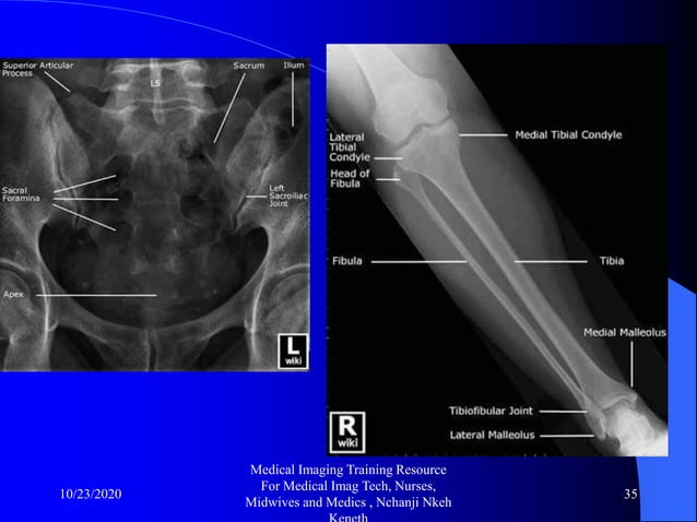 Lower limbs x ray radiology training resource nchanji nkeh keneth | PPT