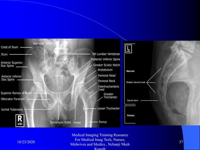 Lower limbs x ray radiology training resource nchanji nkeh keneth | PPT