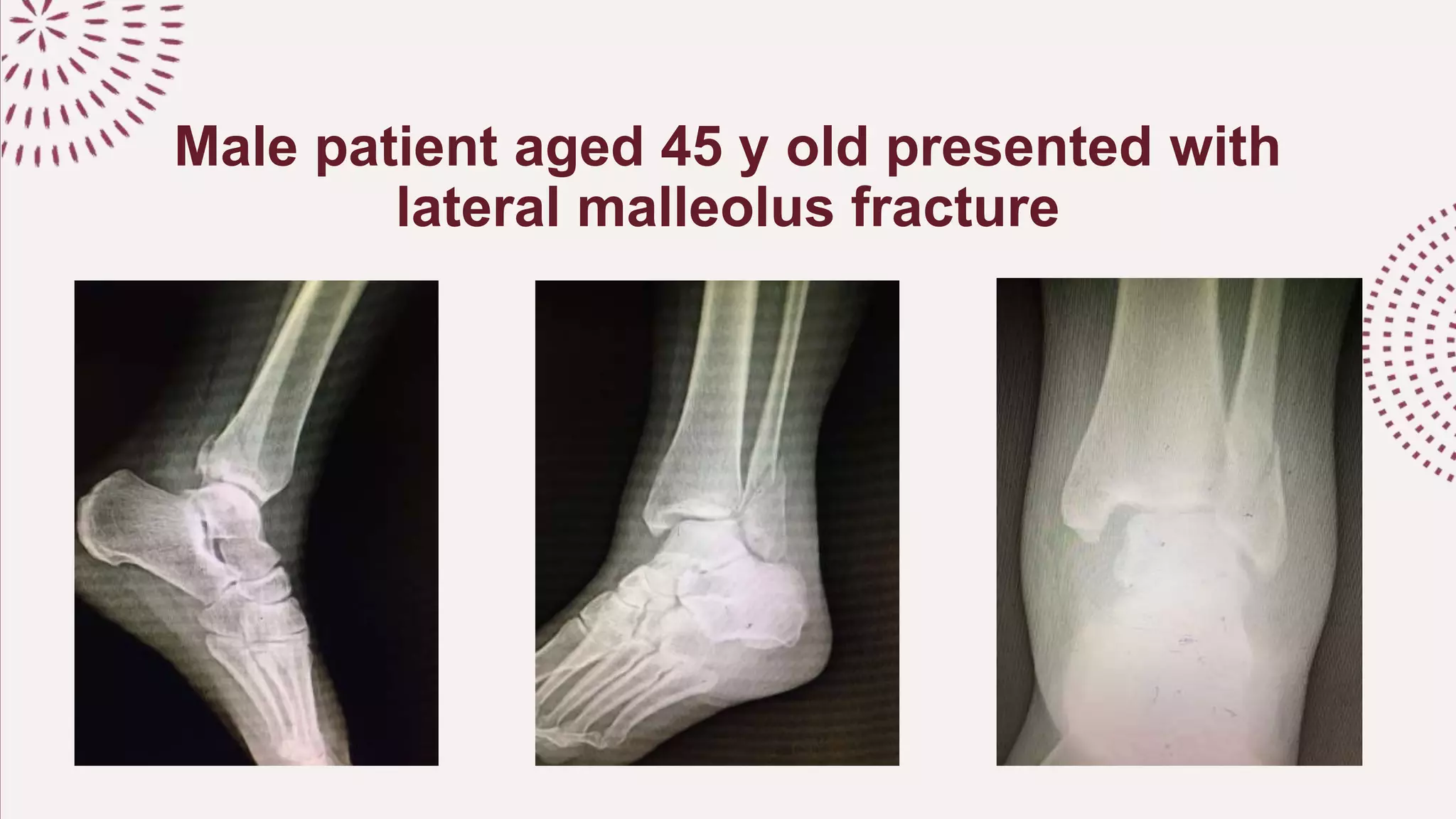 Lower limb trauma case.pptx