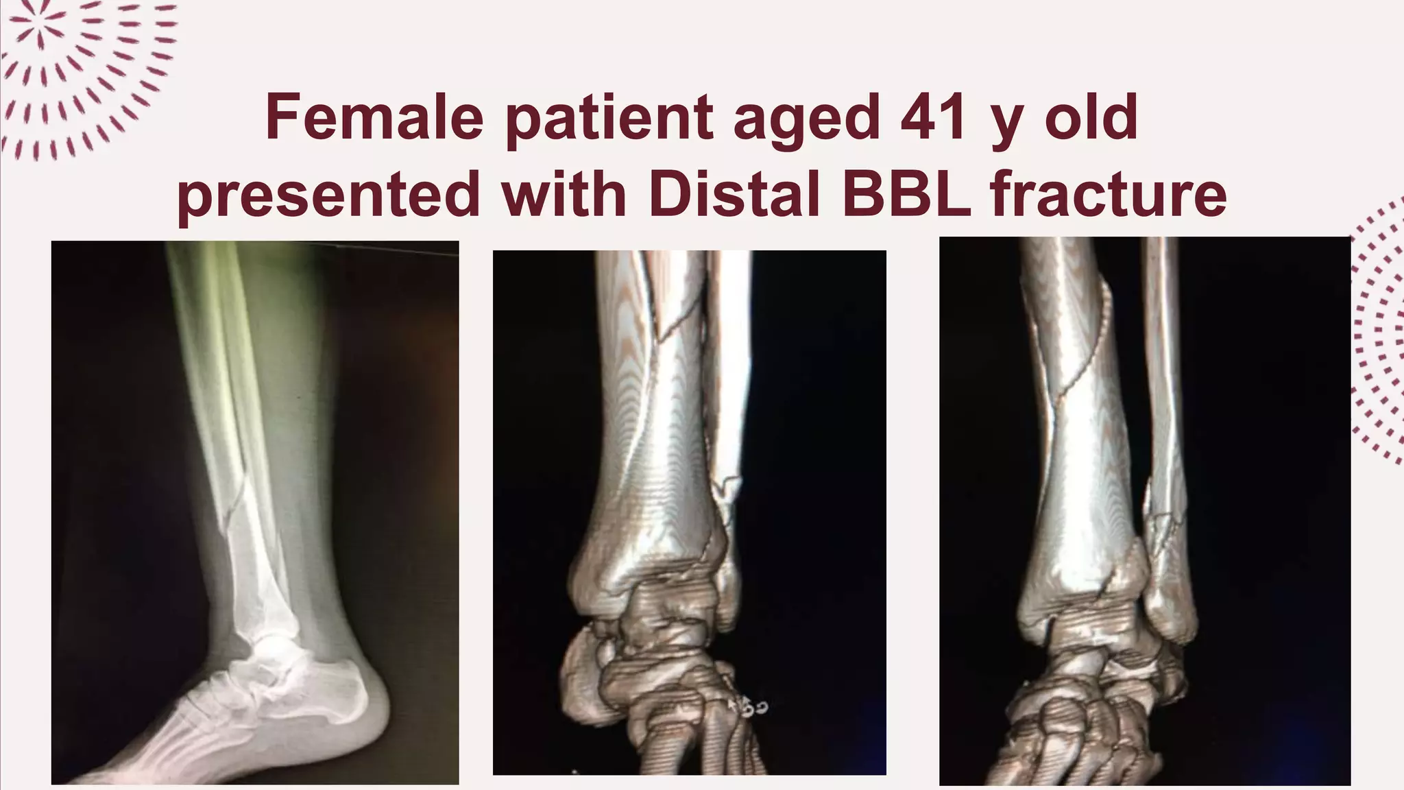 Lower limb trauma case.pptx