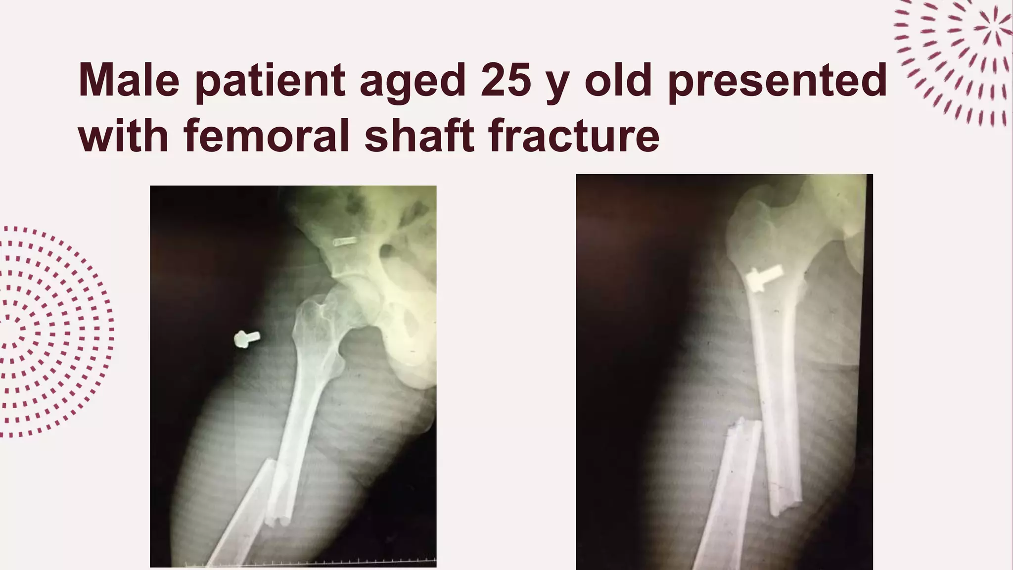 Lower limb trauma case.pptx