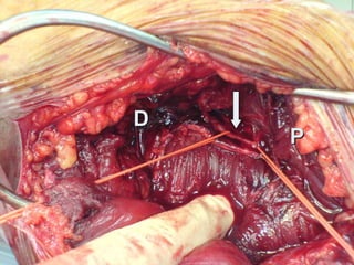 Lower Limb Vascular Trauma | PPTX