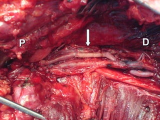 Lower Limb Vascular Trauma | PPTX