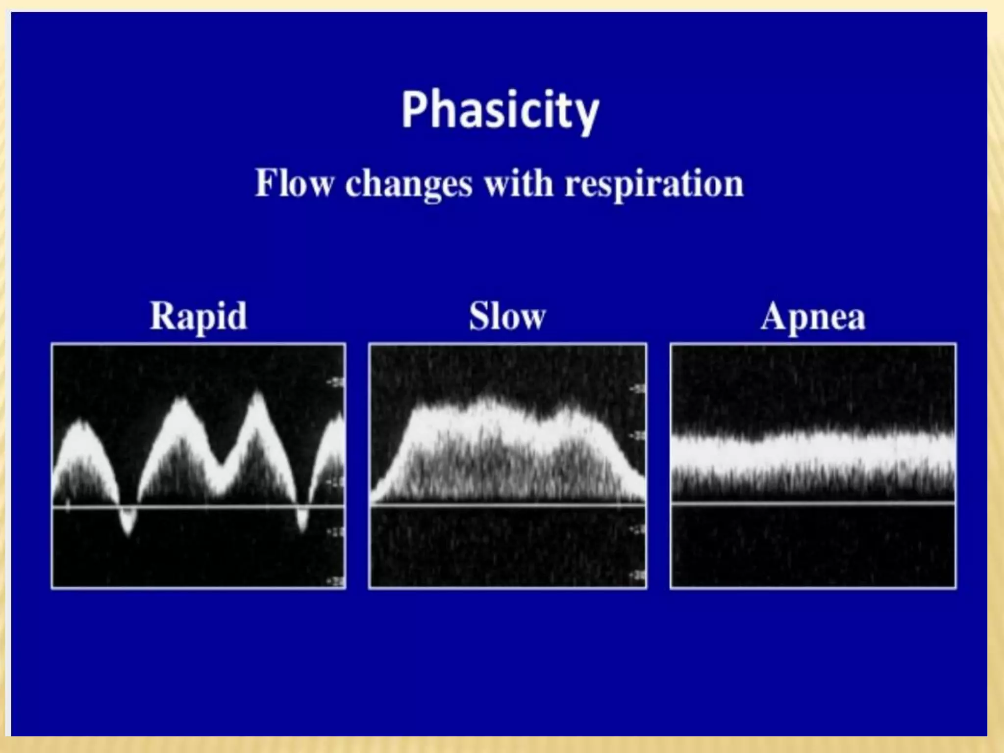 Venous Doppler Lower limb Dr Mukesh Tilgam | PPTX