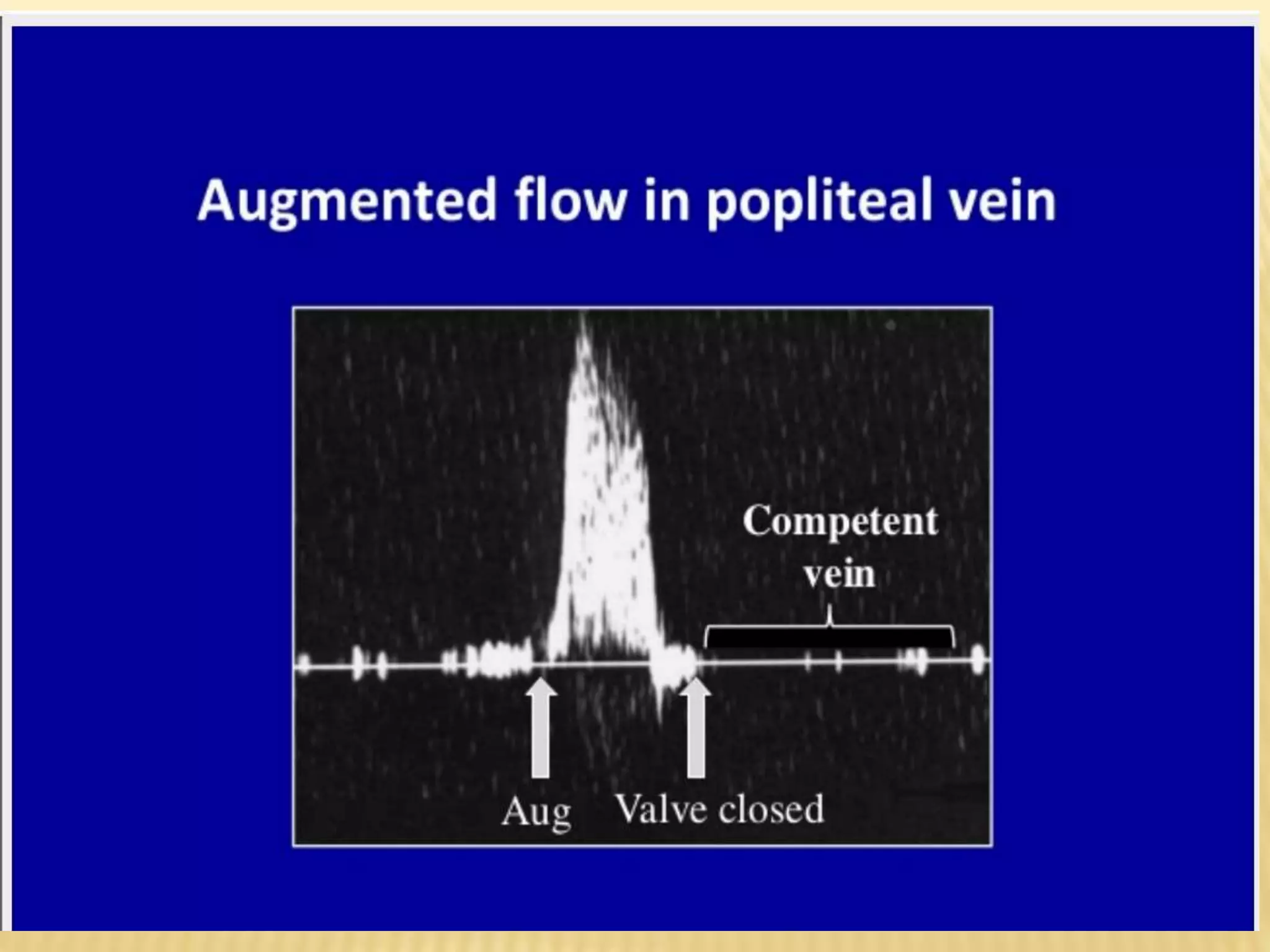Venous Doppler Lower limb Dr Mukesh Tilgam | PPTX