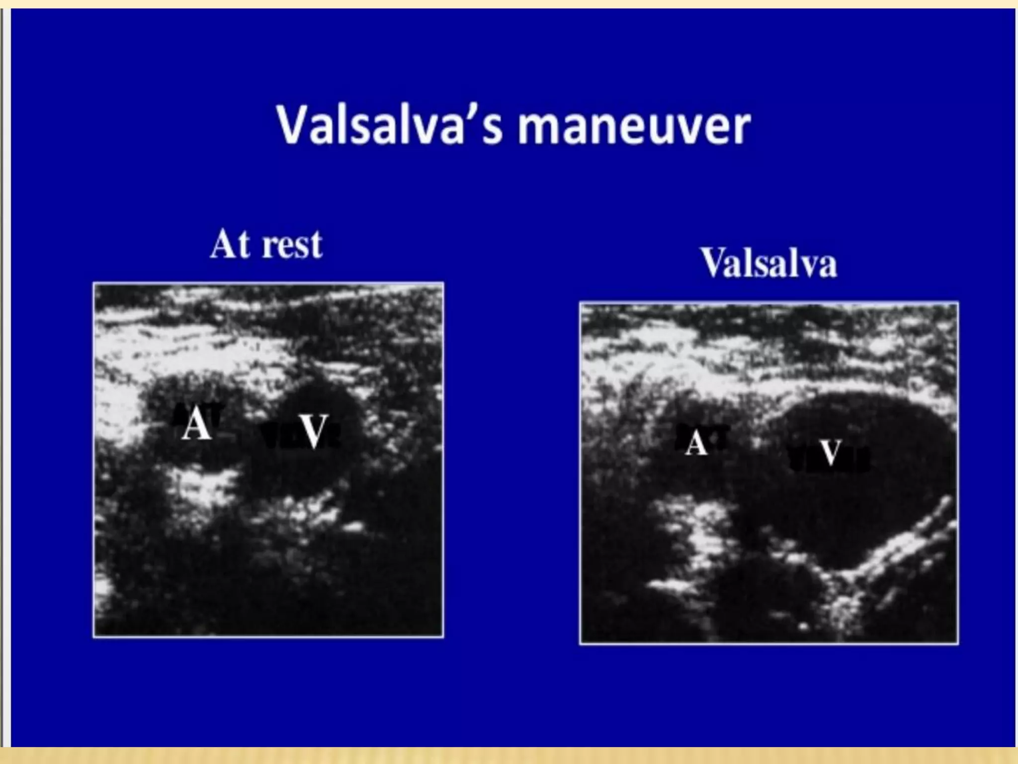 Venous Doppler Lower limb Dr Mukesh Tilgam | PPTX