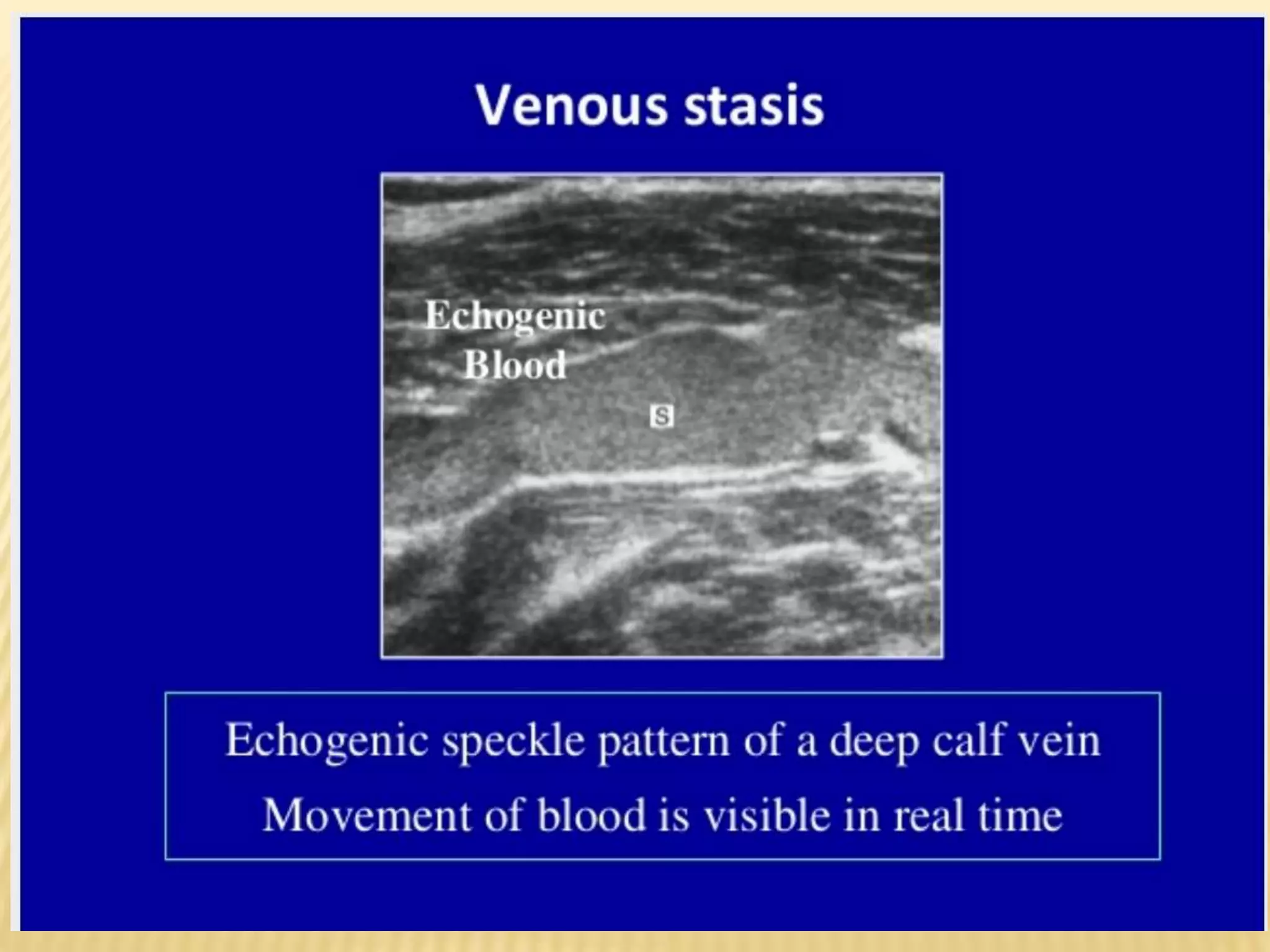 Venous Doppler Lower limb Dr Mukesh Tilgam | PPTX