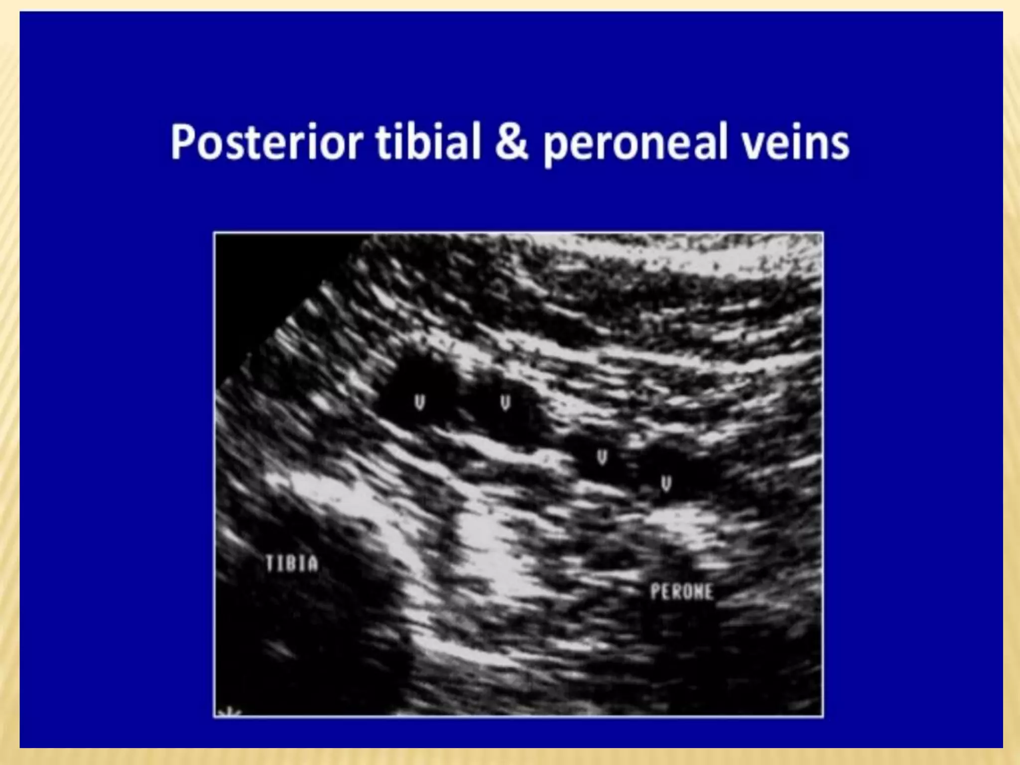 Venous Doppler Lower limb Dr Mukesh Tilgam | PPTX