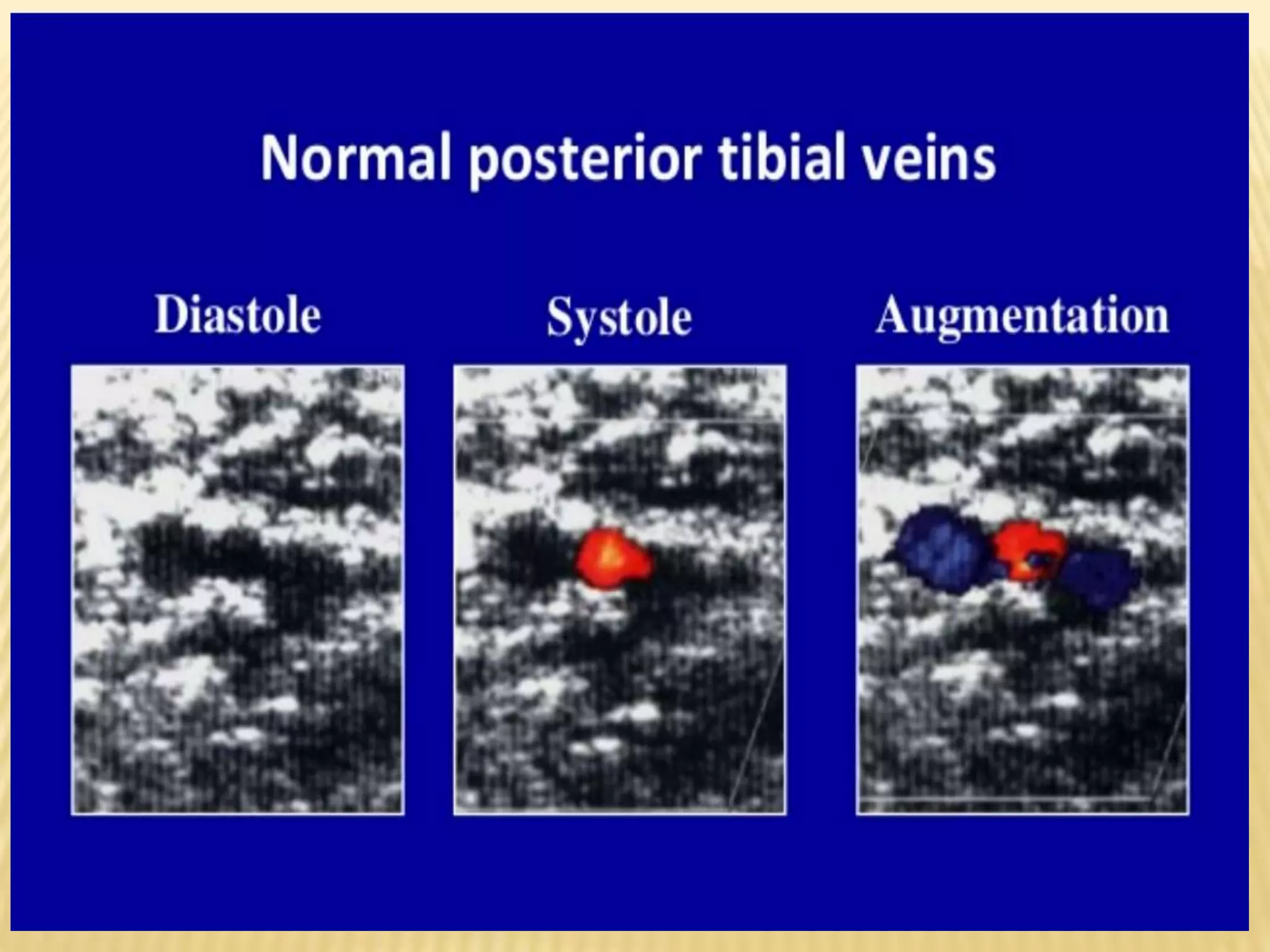 Venous Doppler Lower limb Dr Mukesh Tilgam | PPTX