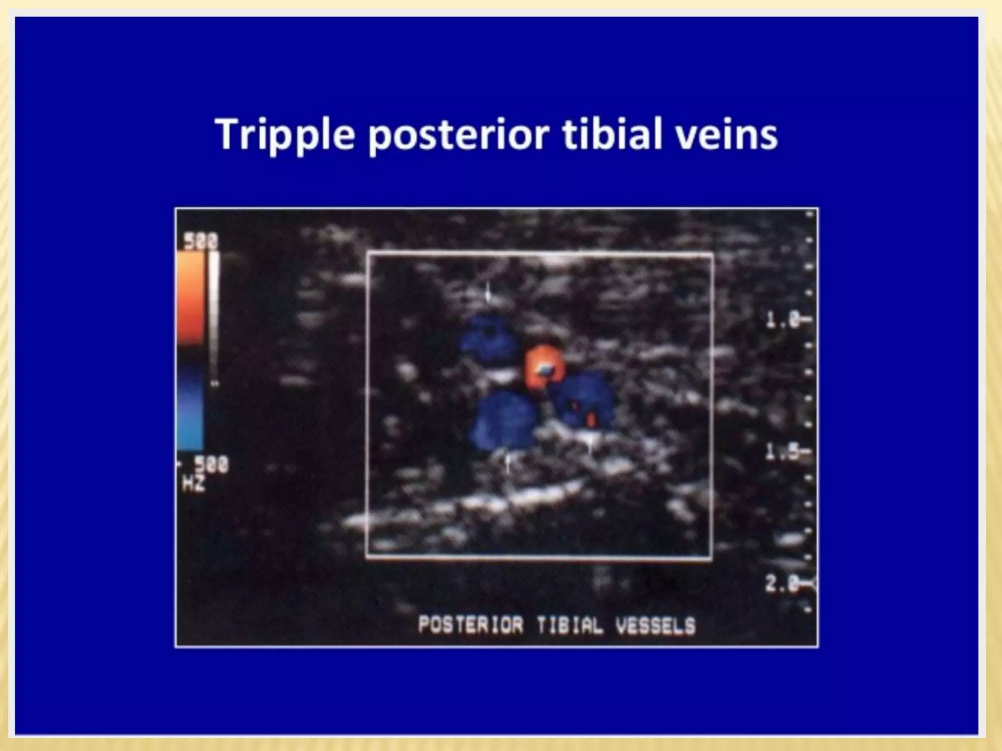 Venous Doppler Lower limb Dr Mukesh Tilgam | PPTX