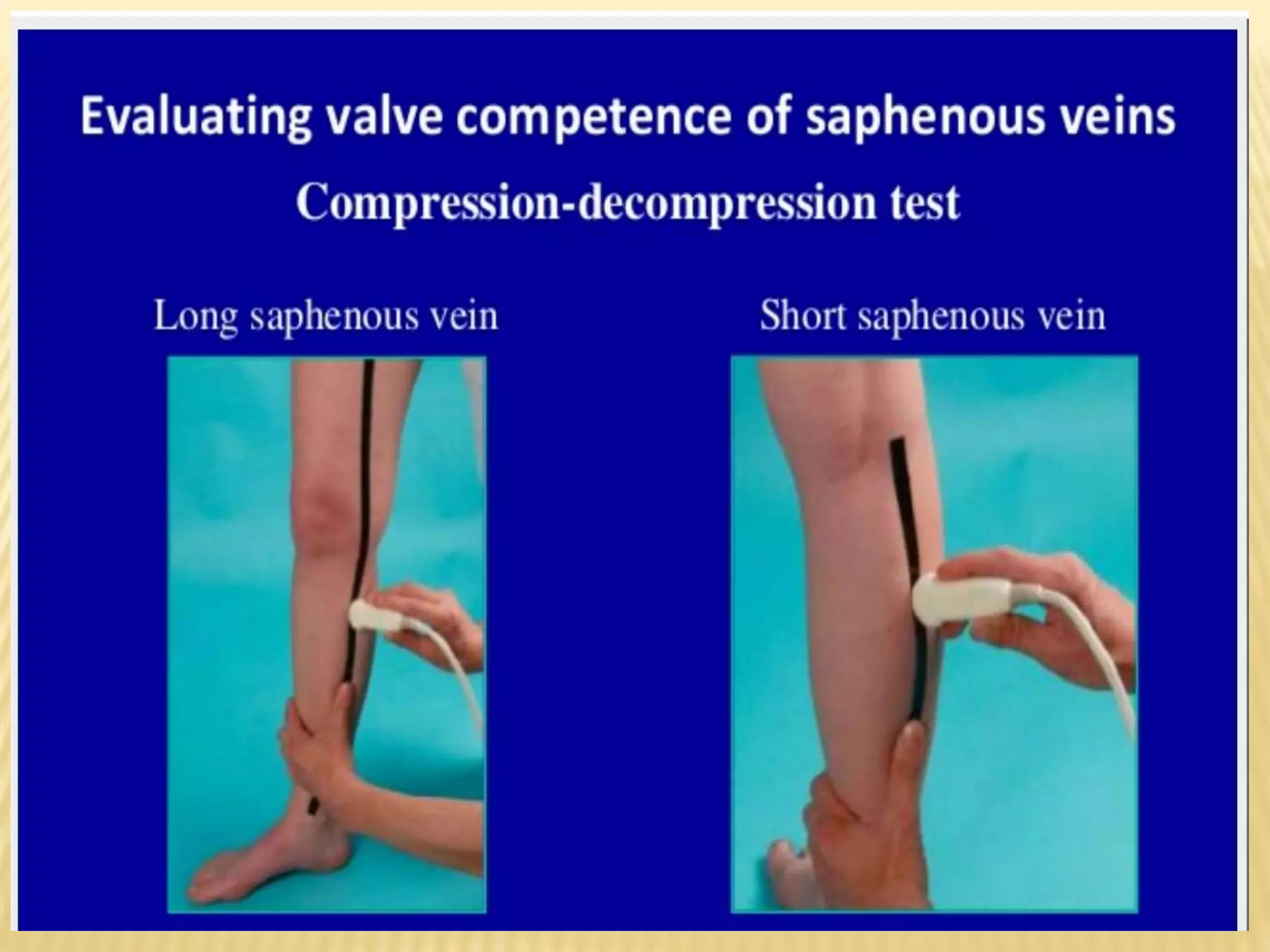 Venous Doppler Lower limb Dr Mukesh Tilgam | PPTX