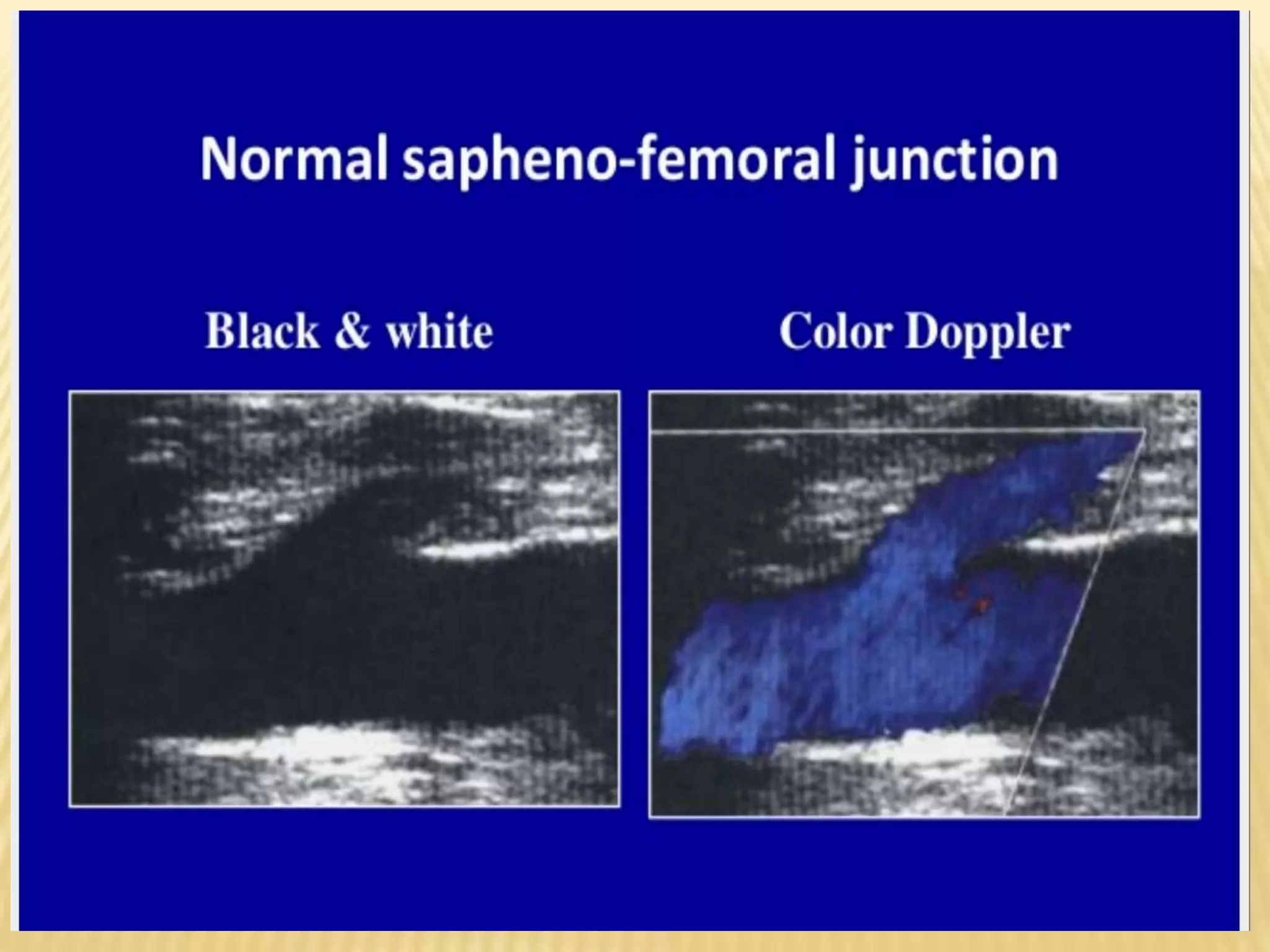 Venous Doppler Lower limb Dr Mukesh Tilgam | PPTX