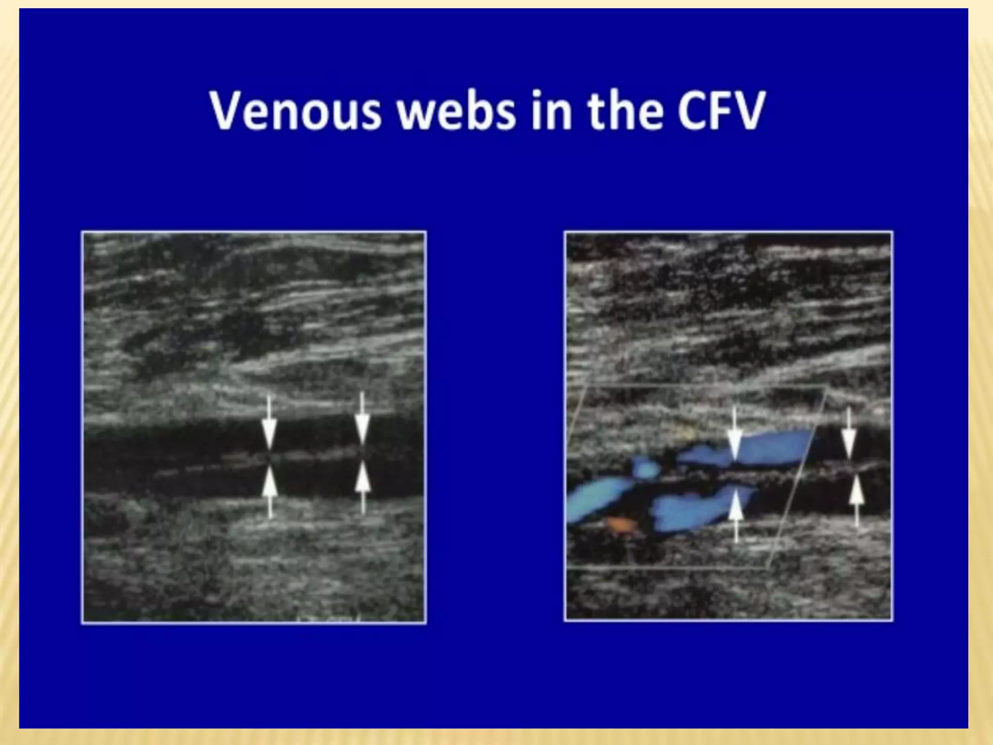 Venous Doppler Lower limb Dr Mukesh Tilgam | PPTX