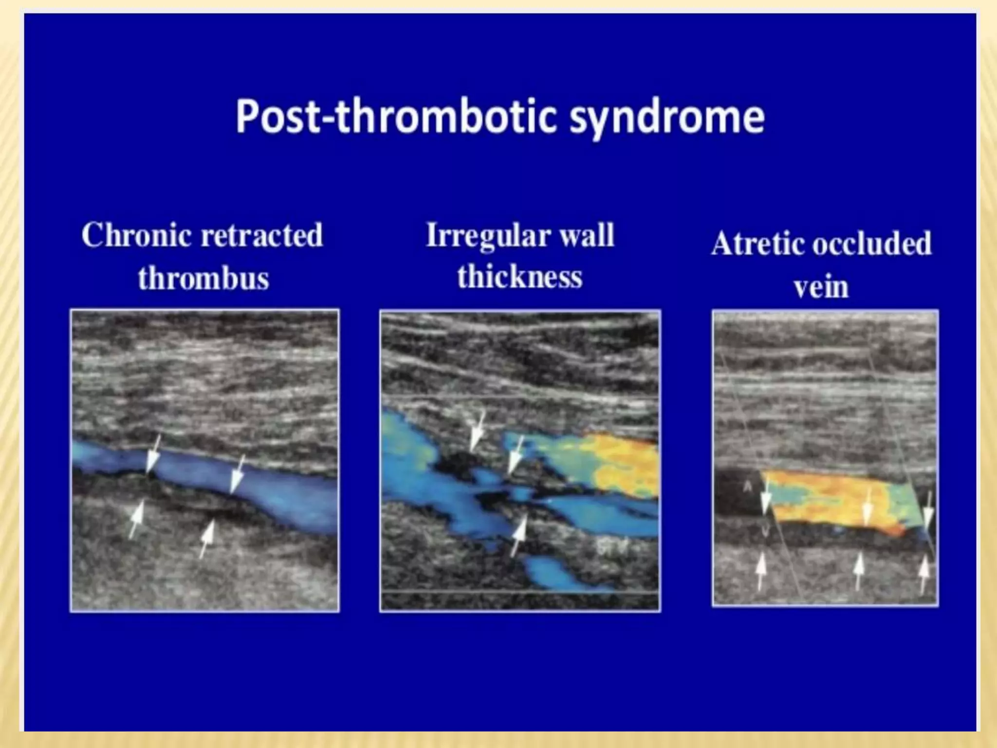 Venous Doppler Lower limb Dr Mukesh Tilgam | PPTX