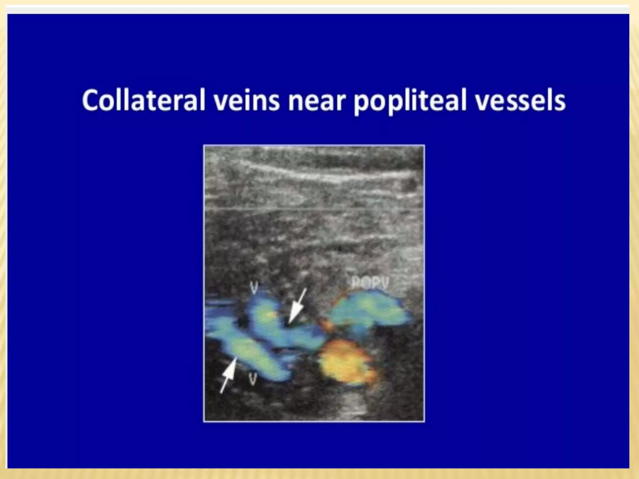 Venous Doppler Lower limb Dr Mukesh Tilgam | PPTX