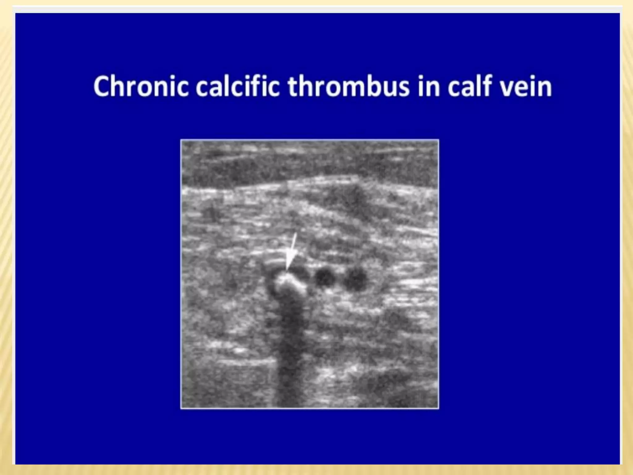 Venous Doppler Lower limb Dr Mukesh Tilgam | PPTX