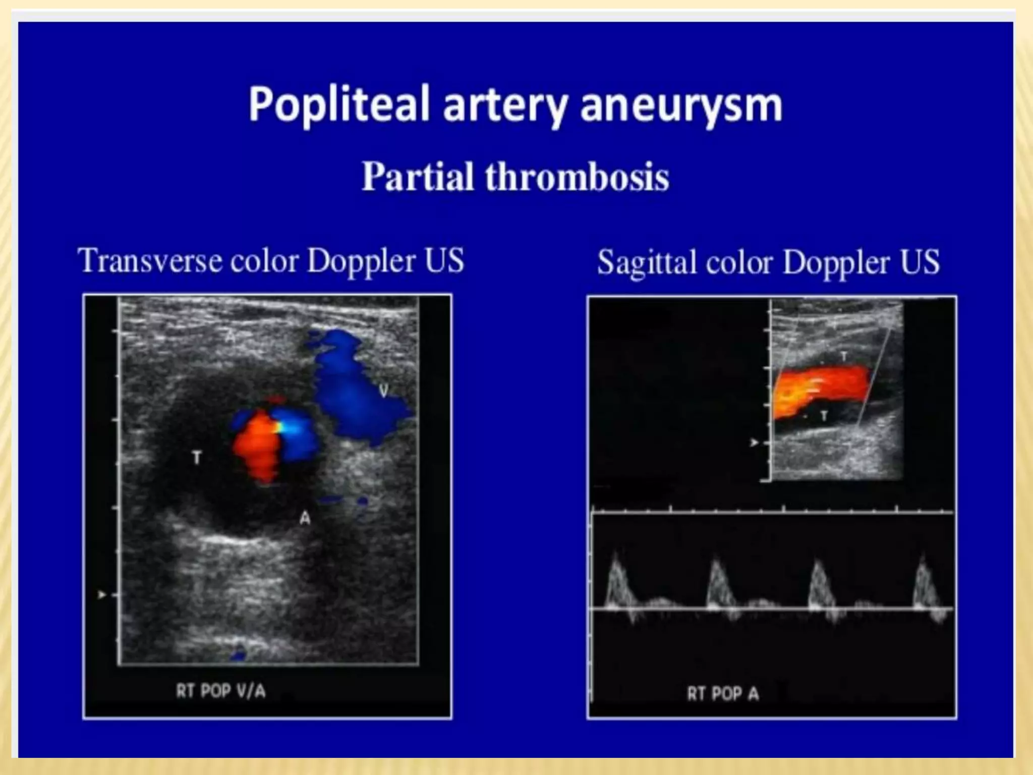 Venous Doppler Lower limb Dr Mukesh Tilgam | PPTX