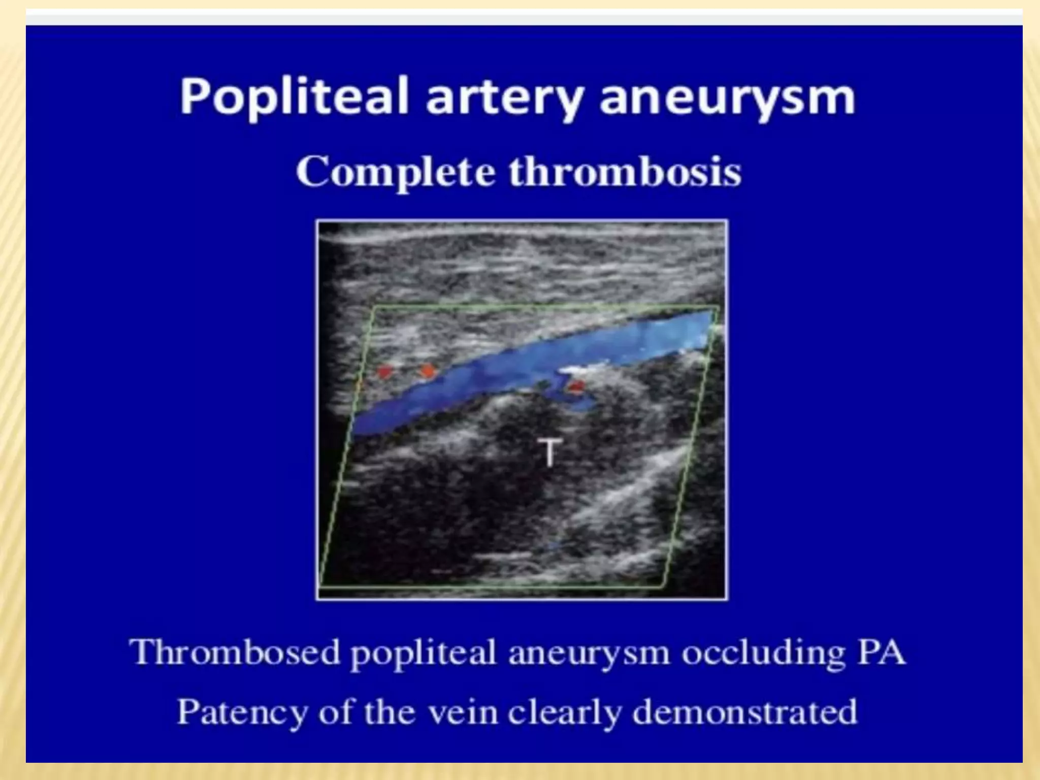 Venous Doppler Lower limb Dr Mukesh Tilgam | PPTX