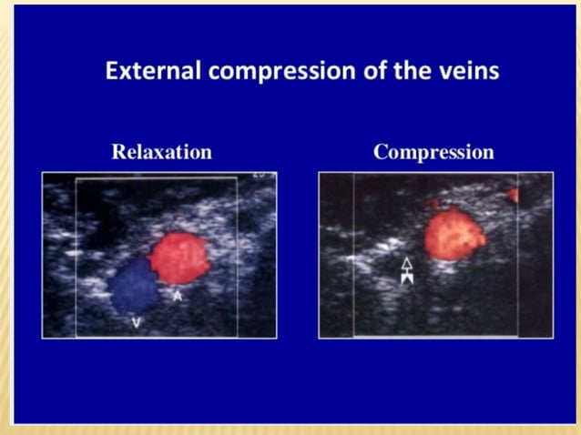 Venous Doppler Lower limb Dr Mukesh Tilgam | PPTX