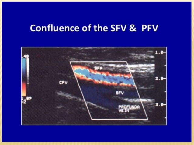Venous Doppler Lower limb Dr Mukesh Tilgam | PPTX