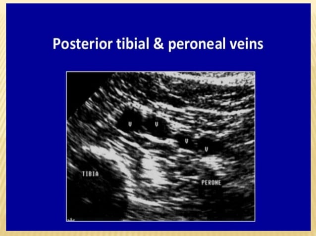 Venous Doppler Lower limb Dr Mukesh Tilgam | PPTX