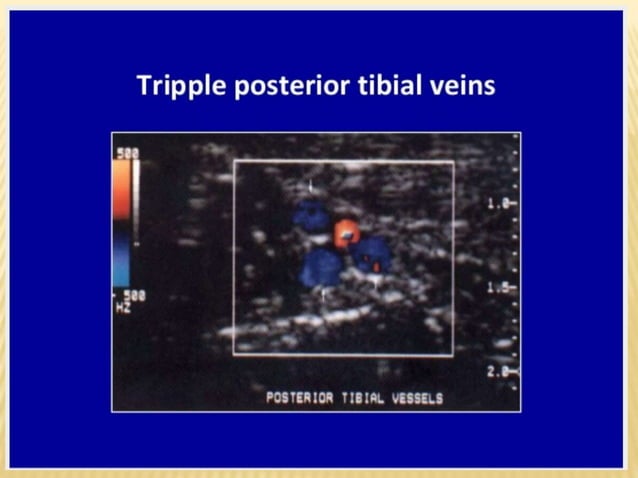 Venous Doppler Lower limb Dr Mukesh Tilgam | PPTX