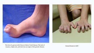 Spinal cord disease and Lower motor neurone disorders in Paediatrics | PDF